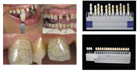 Custom Shade Match – Professional Dental Labs